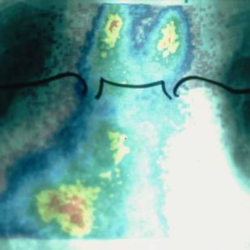 07 IV Paraffin Plombage/Oleothorax and Acute Pleural Empyema – Schmitt ...